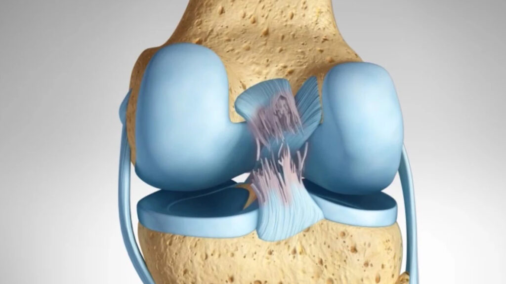 PCL Injury - High Street Clinic
