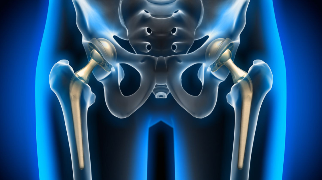 Hip Replacement - High Street Clinic